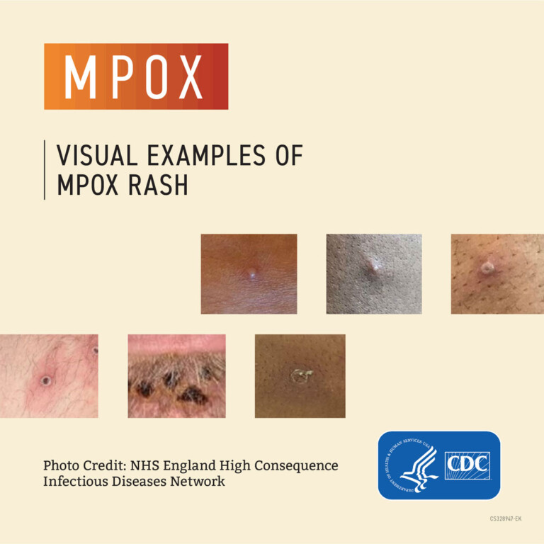 Duval has nation’s highest risk of mpox outbreak | Jacksonville Today
