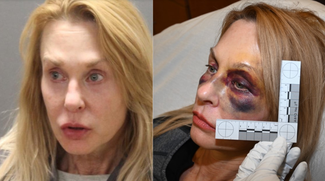 Jailers say inmate had no visible injuries. Photos show otherwise ...